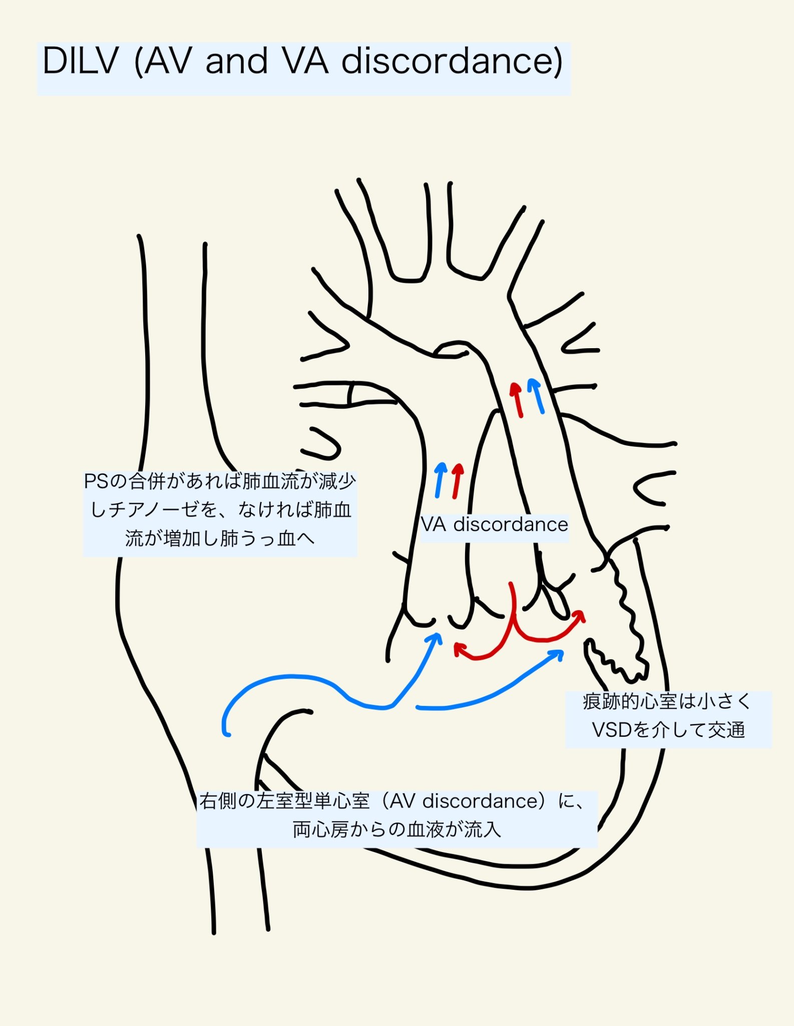 単心室疾患：DILVやheterotaxy syndrome（無脾症を含む）など | シェアする挑戦者