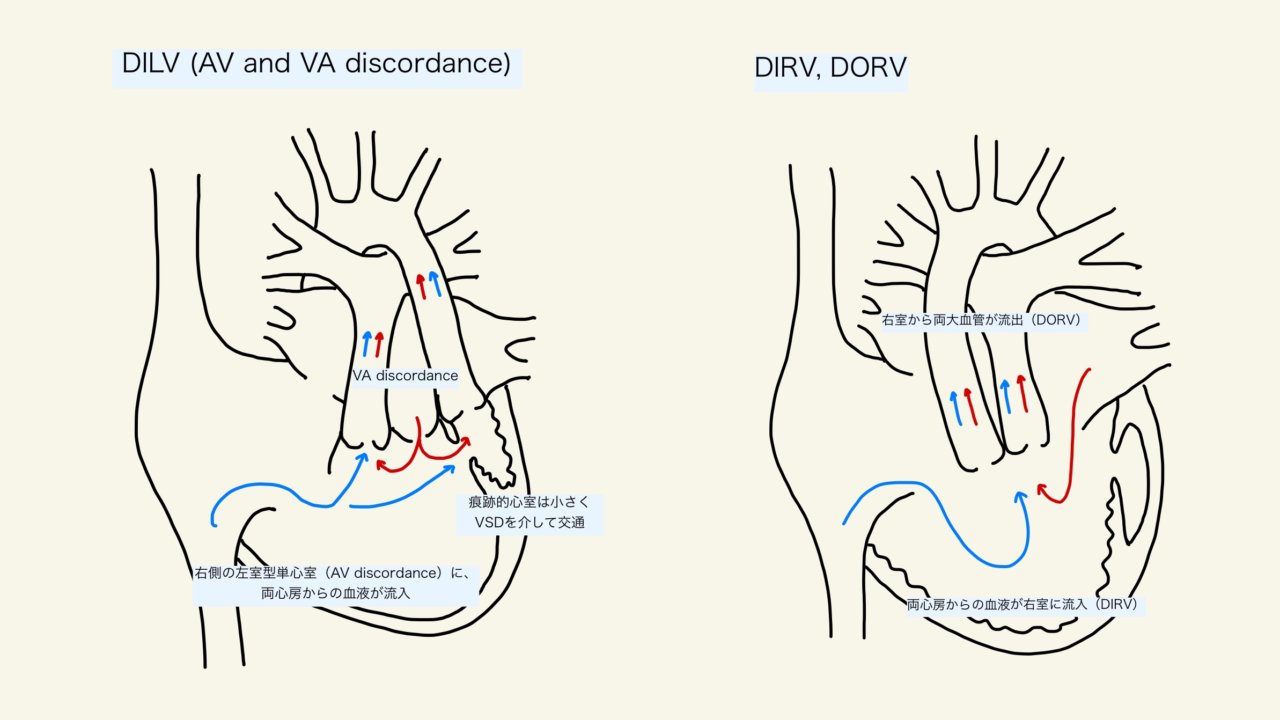 単心室疾患：DILVやheterotaxy syndrome（無脾症を含む）など｜シェアする挑戦者 〜 MD × MPH