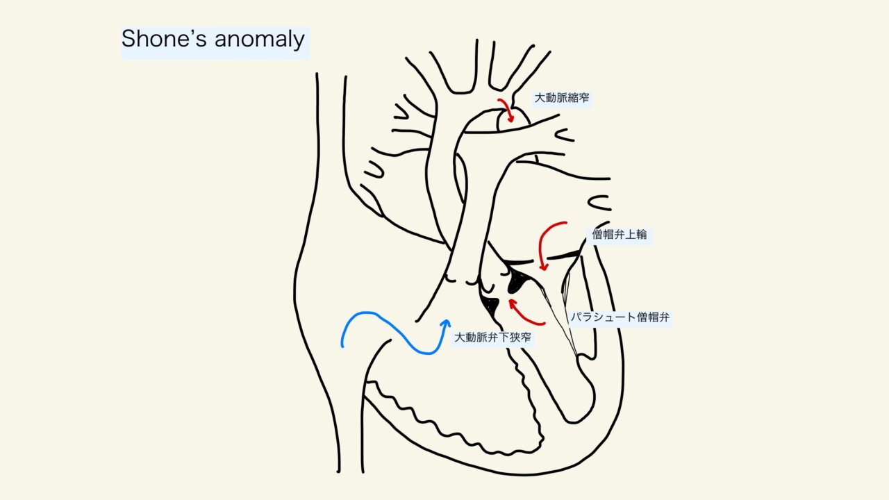Shone複合の周術期管理｜シェアする挑戦者 〜 MD × MPH