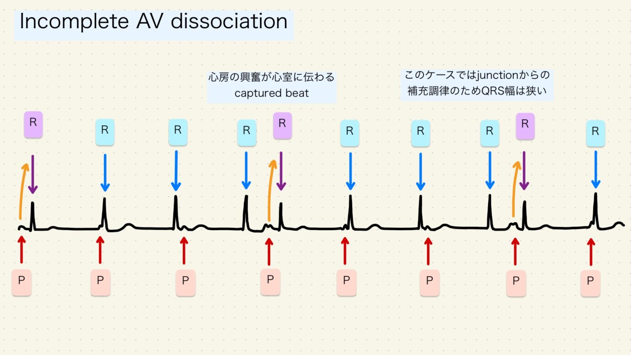 房室解離｜シェアする挑戦者 〜 MD × MPH